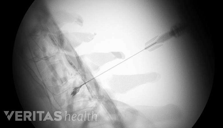 Selective Nerve Root Block Injections Spine Health