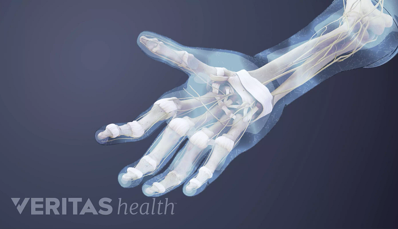 Recognizing Osteoarthritis In The Hand Arthritis Health