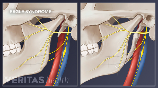 Styloid Process Of Temporal Bone Styloid Process Of Temporal Bone