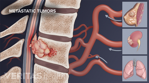 Cancerous Lumps On Back