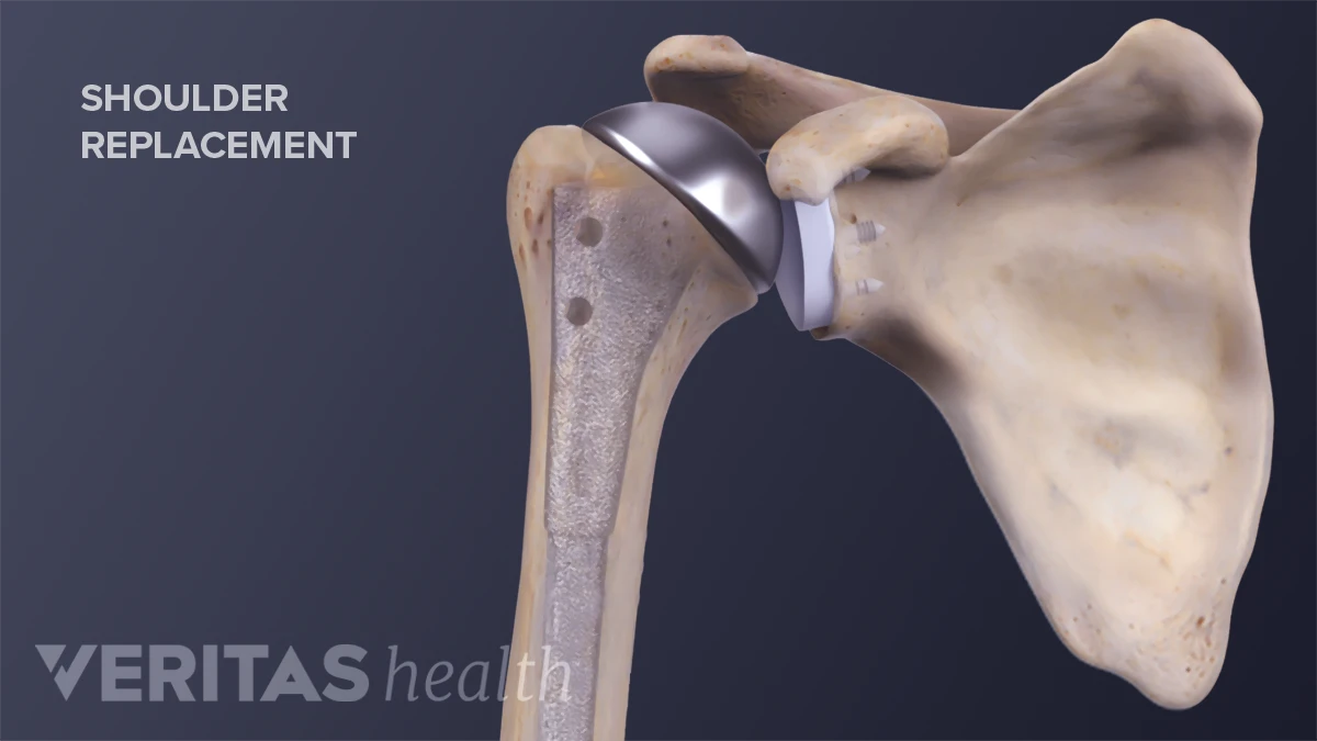 Shoulder Surgery Arthritis Health